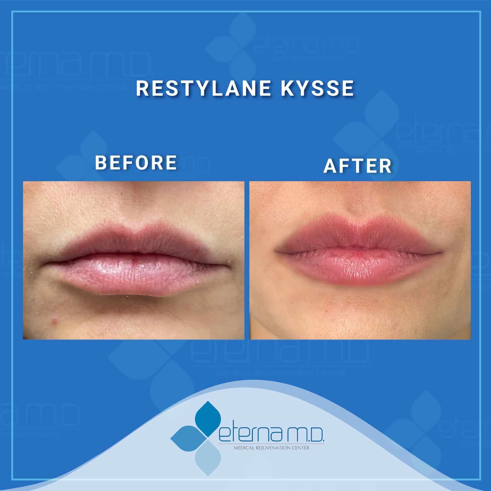 Eterna-MD_Restylane-Kysse-Patient | Eterna MD